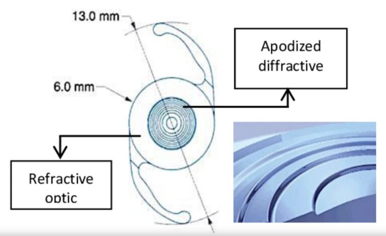Best Premium Cataract Lenses in 2026 - Eye MDs of Inland